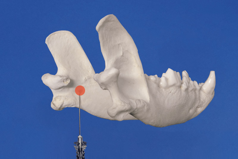 Bloqueo del Nervio Caudal Inferior Alveolar